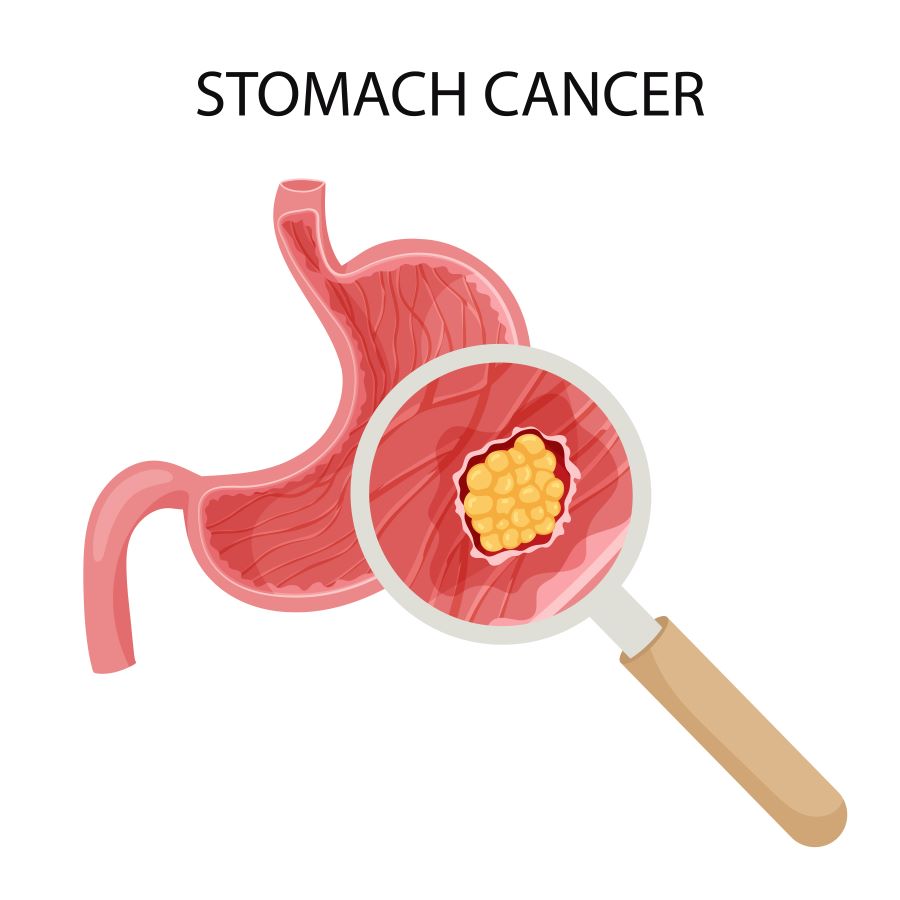 Can Stomach Ulcers Increase the Risk of Stomach Cancer? Exploring the ...