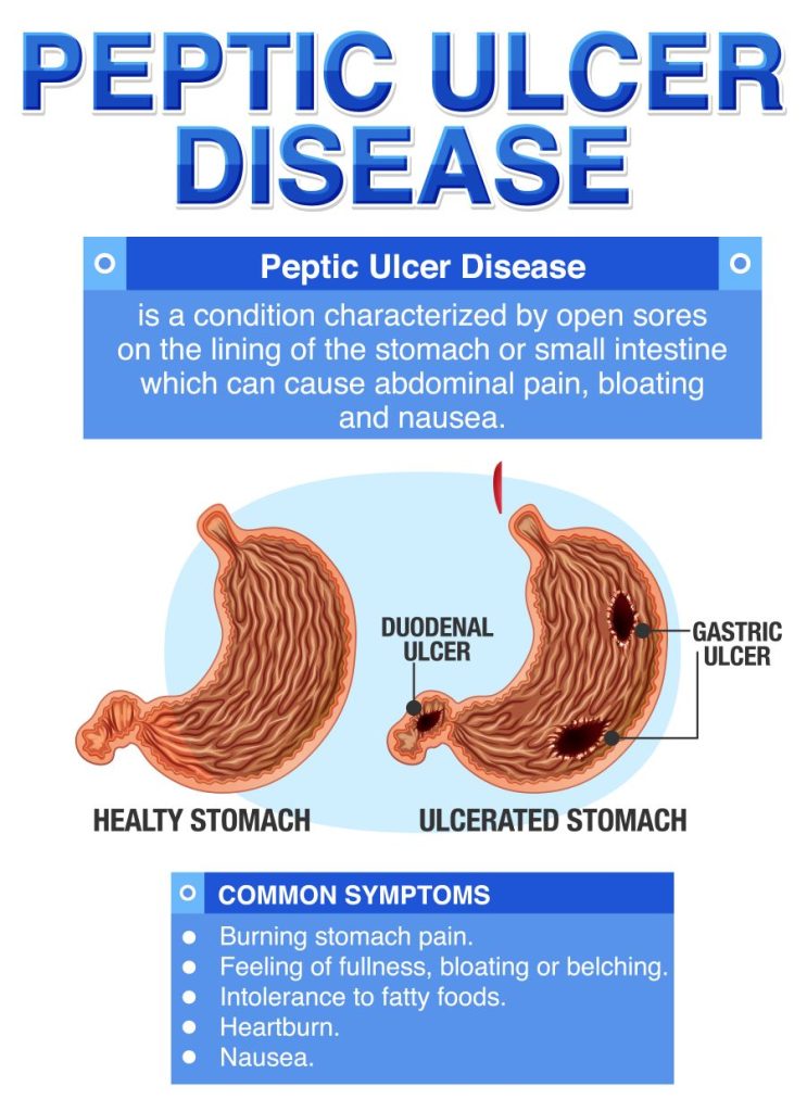 Can Stomach Ulcers Increase the Risk of Stomach Cancer? Exploring the ...