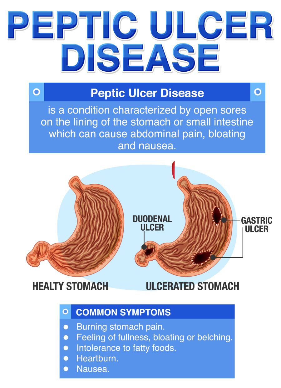 Can Stomach Ulcers Increase the Risk of Stomach Cancer? Exploring the ...