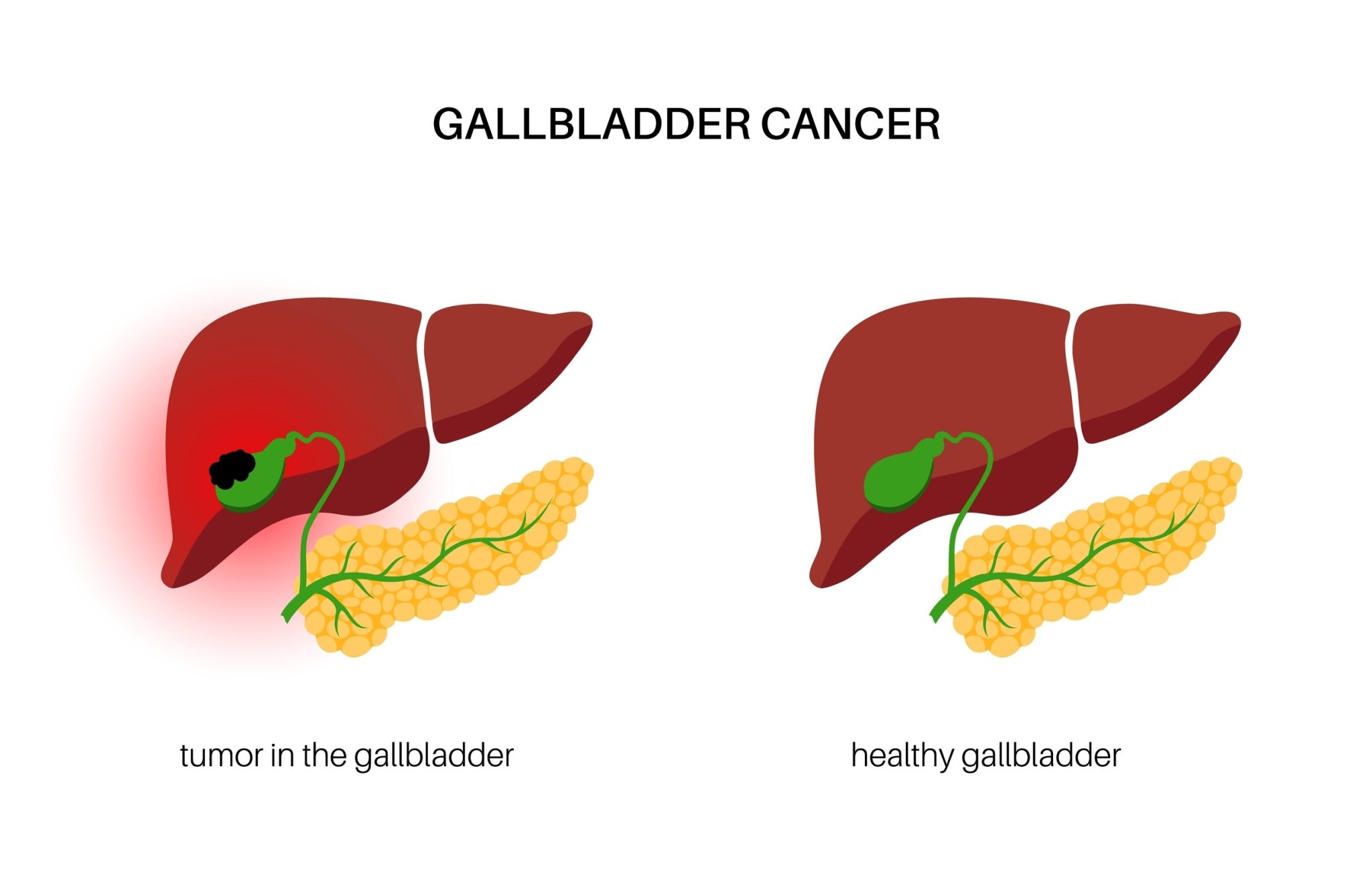 Understanding Gallbladder Cancer: Symptoms, Causes, Diagnosis, and ...
