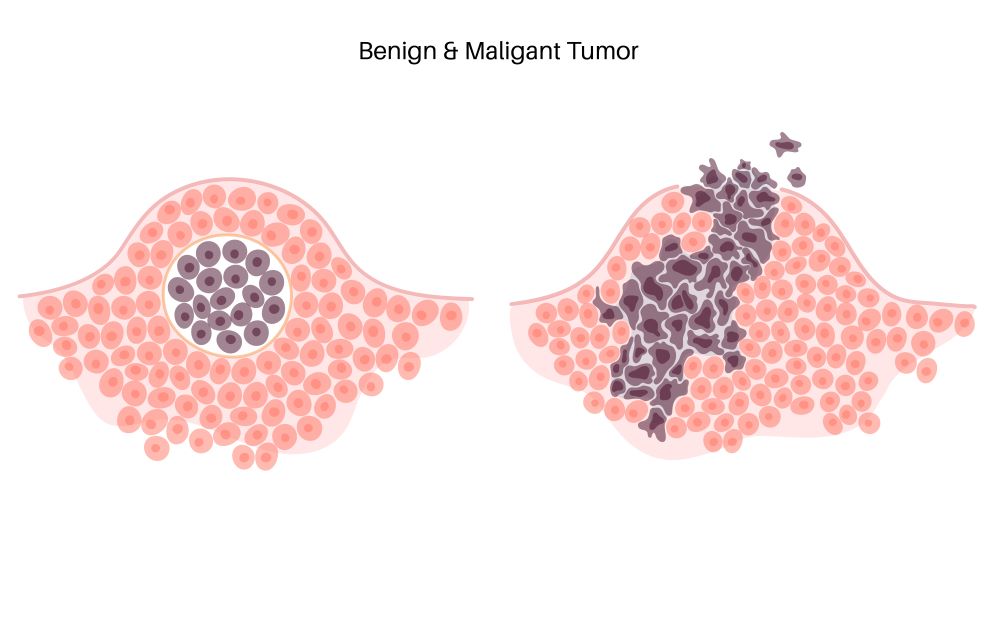 Benign vs. Malignant Tumours: Key Differences Explained