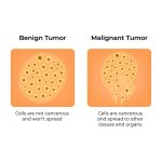 Benign vs. Malignant Tumours: Key Differences Explained