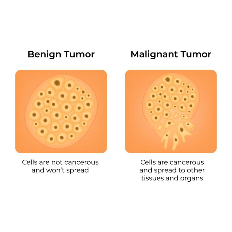 Benign vs. Malignant Tumours: Key Differences Explained