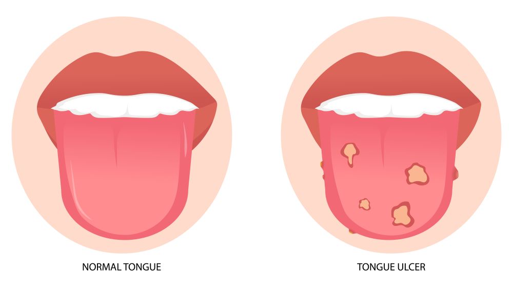 Recognizing Tongue Cancer: Symptoms, Risks, and Treatment