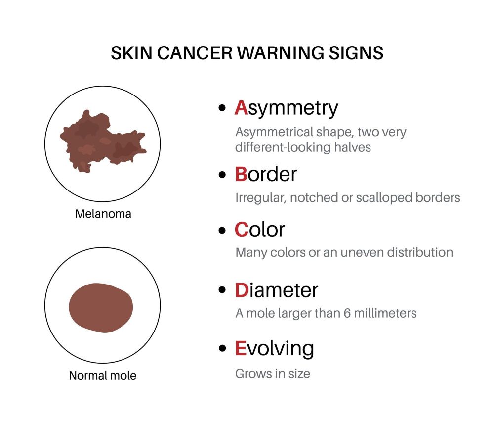 Early Signs of Melanoma You Shouldn’t Ignore: Dermatologists Explain