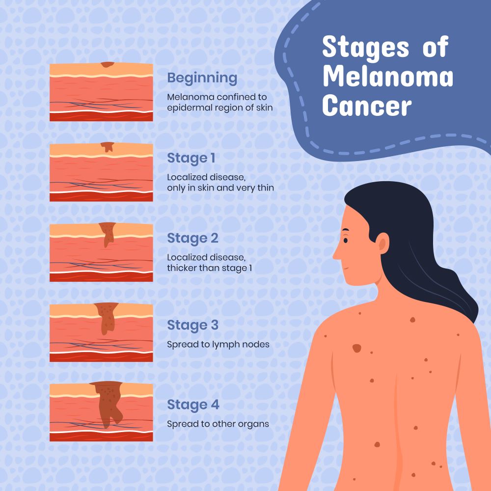 Early Signs of Melanoma You Shouldn’t Ignore: Dermatologists Explain